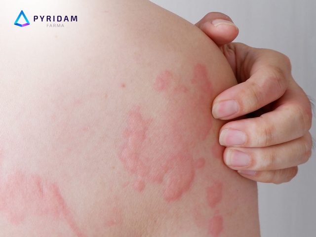 6 Cara Mengobati Kaligata: Minum Obat Hingga Hindari Stres