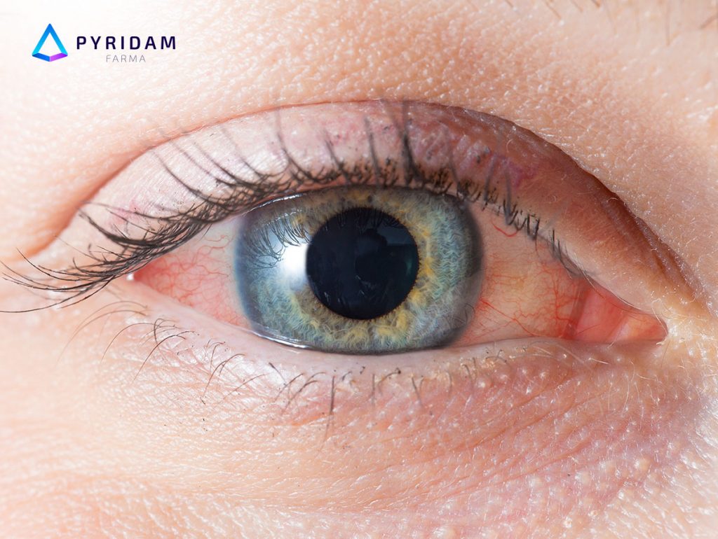 Cara Mengobati Mata Merah yang Aman dan Mudah