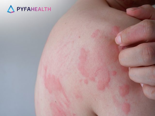 Cara Menghilangkan Gatal di Tubuh Secara Alami dan Cepat