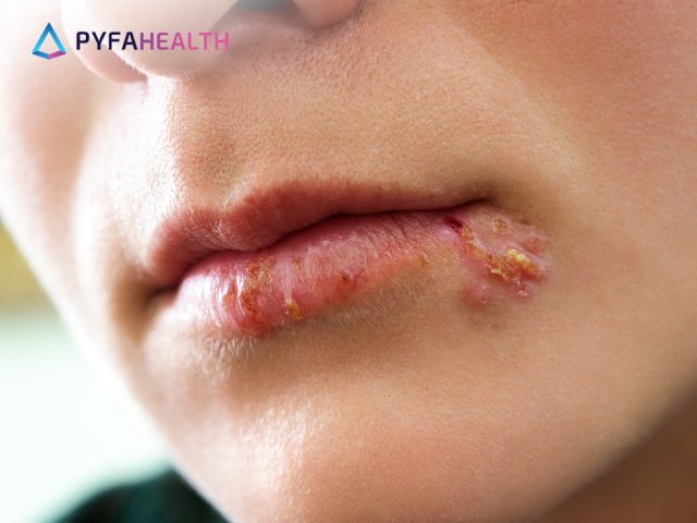 Herpes Labialis: Penyebab, Gejala, Penanganan, dan Pencegahan