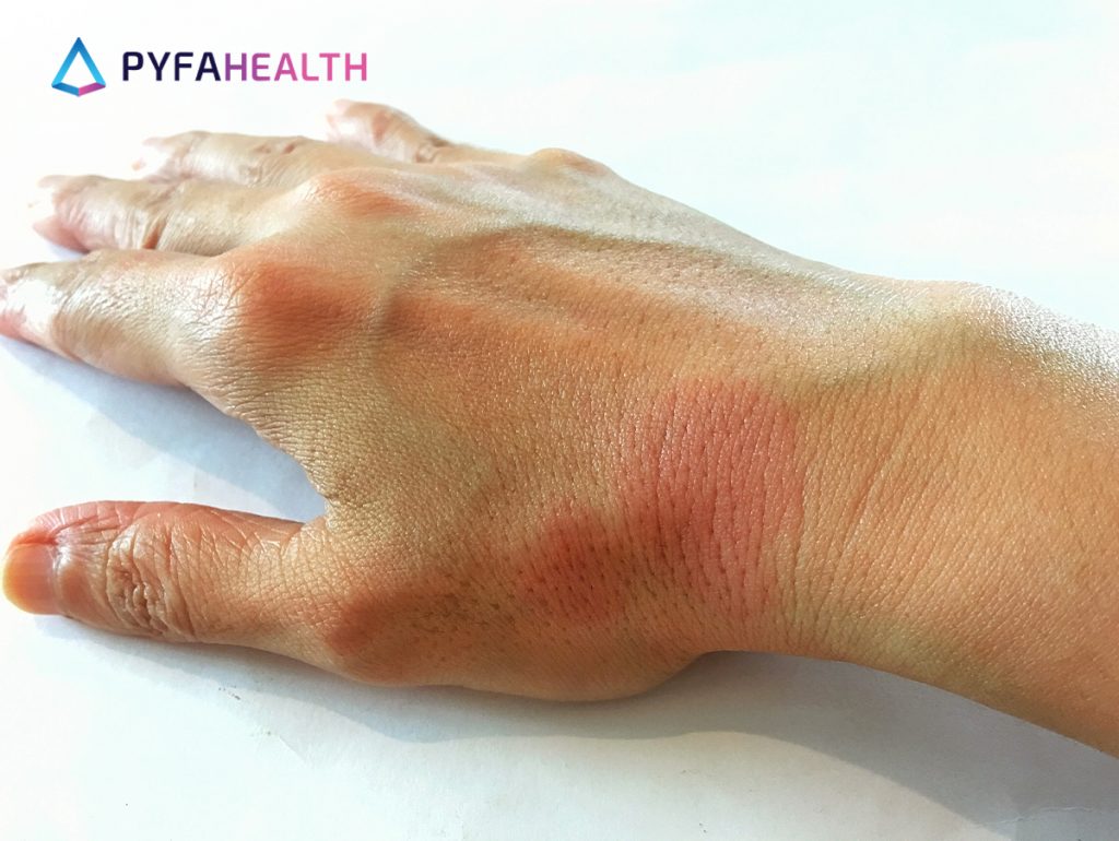 Penyakit Lupus: Penyebab, Gejala, dan Penanganan - PYFA Health