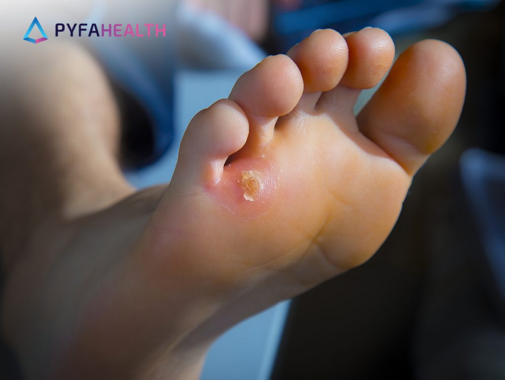 Mata Ikan di Kaki: Penyebab, Penanganan, dan Pencegahannya