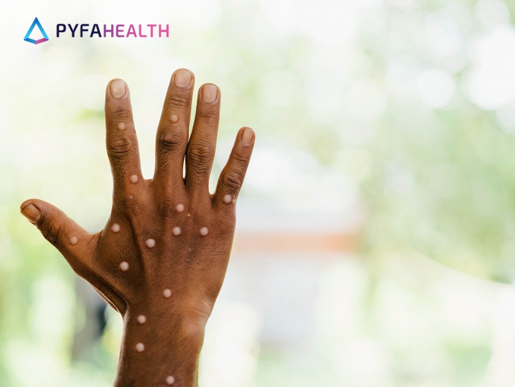 Cacar Monyet Menular Lewat Apa? Ketahui Cara dan Prosesnya - PYFA Health
