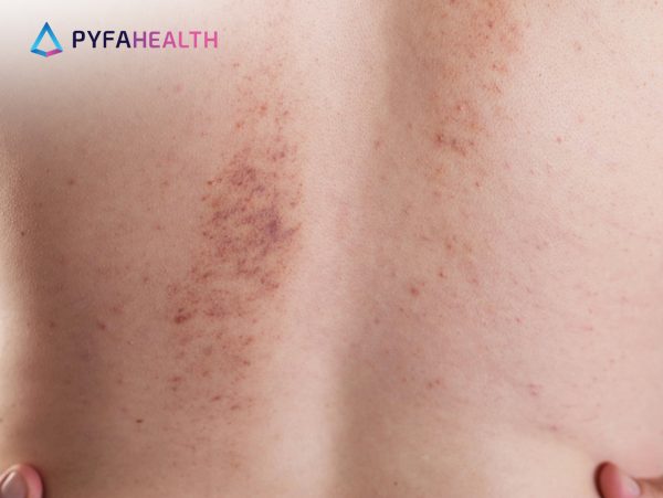 Bintik Merah pada Kulit Tidak Gatal: Penyebab dan Cara Mengatasinya